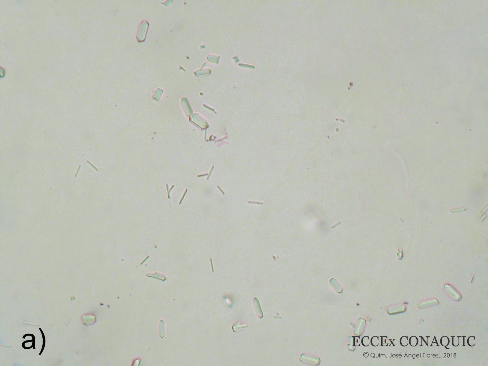 Caso UR-septiembre-18 (Enfoque: cristaluria)
