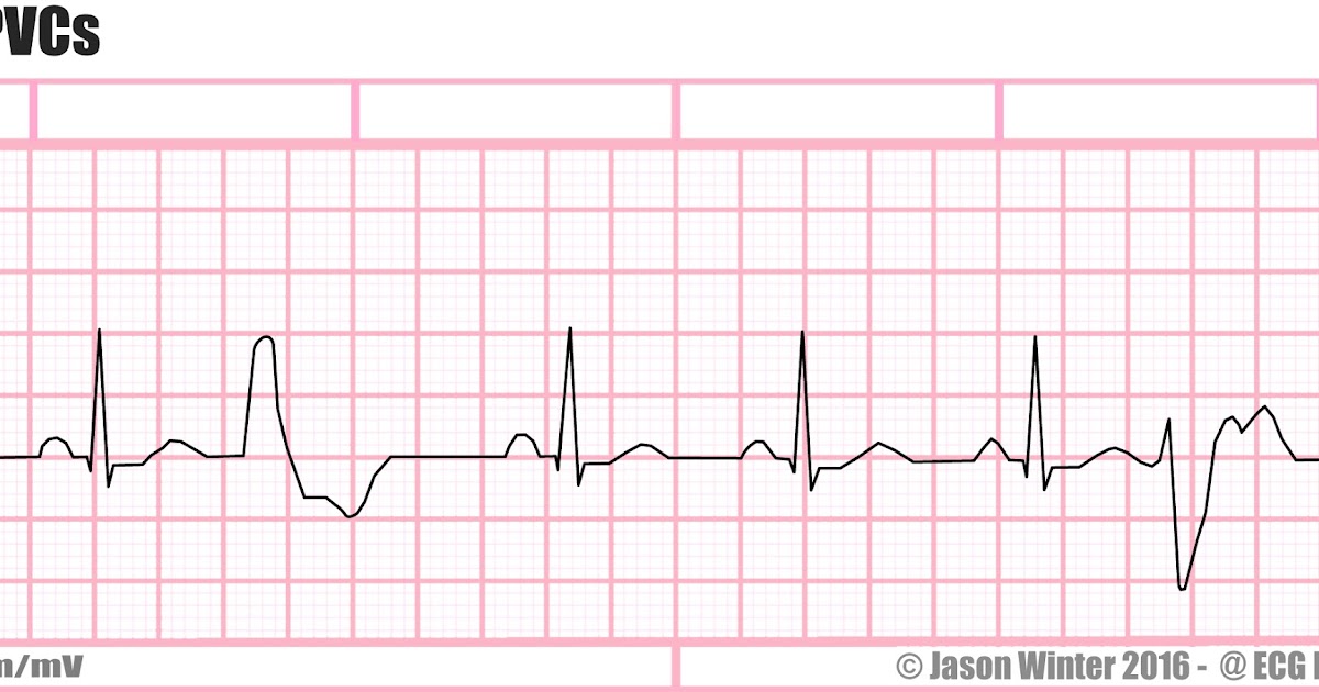 ECG Educator Blog : Multifocal PVCs