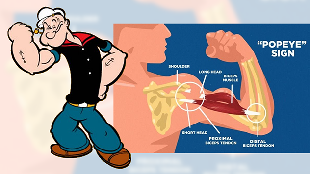 VIETNAMESE MEDIC ULTRASOUND: CASE 478: POPEYE’ SIGN of BICEPS MUSCLE ...