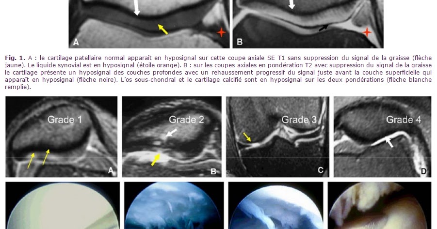 Ma bibliothèque en Imagerie Médicale: Chondropathie au genou