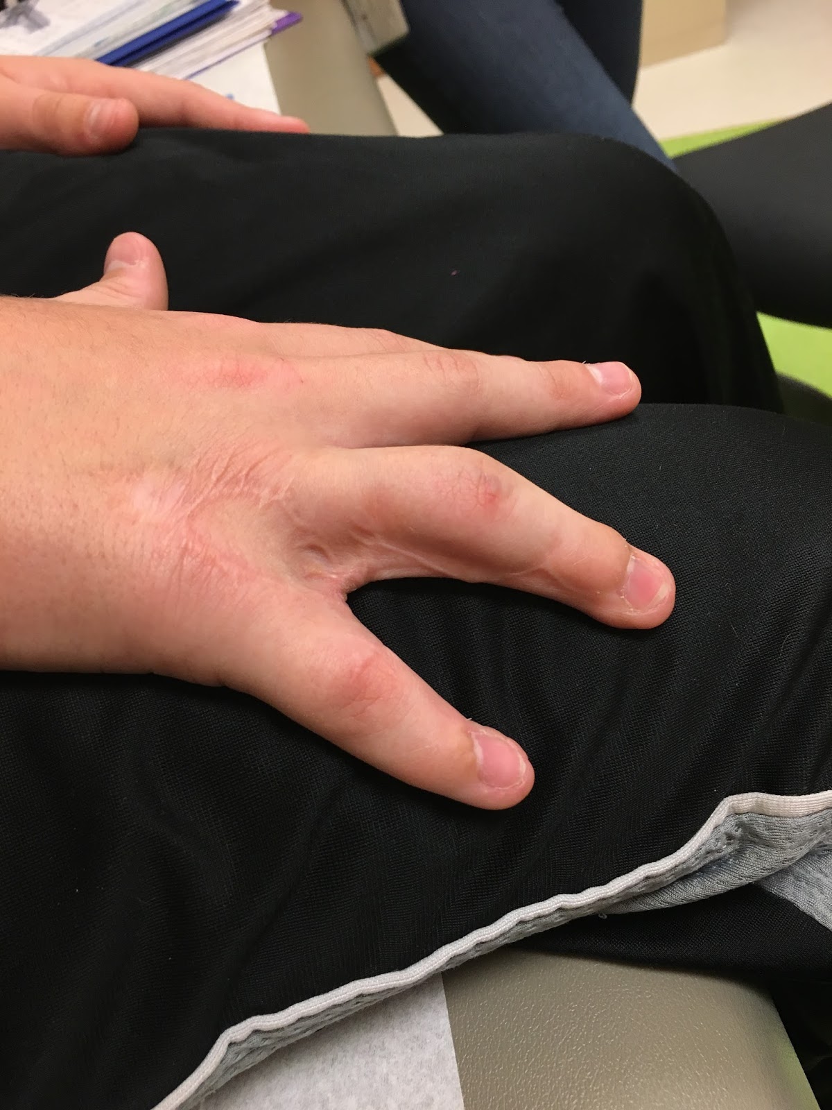 Syndactyly Revision Surgery | Congenital Hand and Arm Differences ...