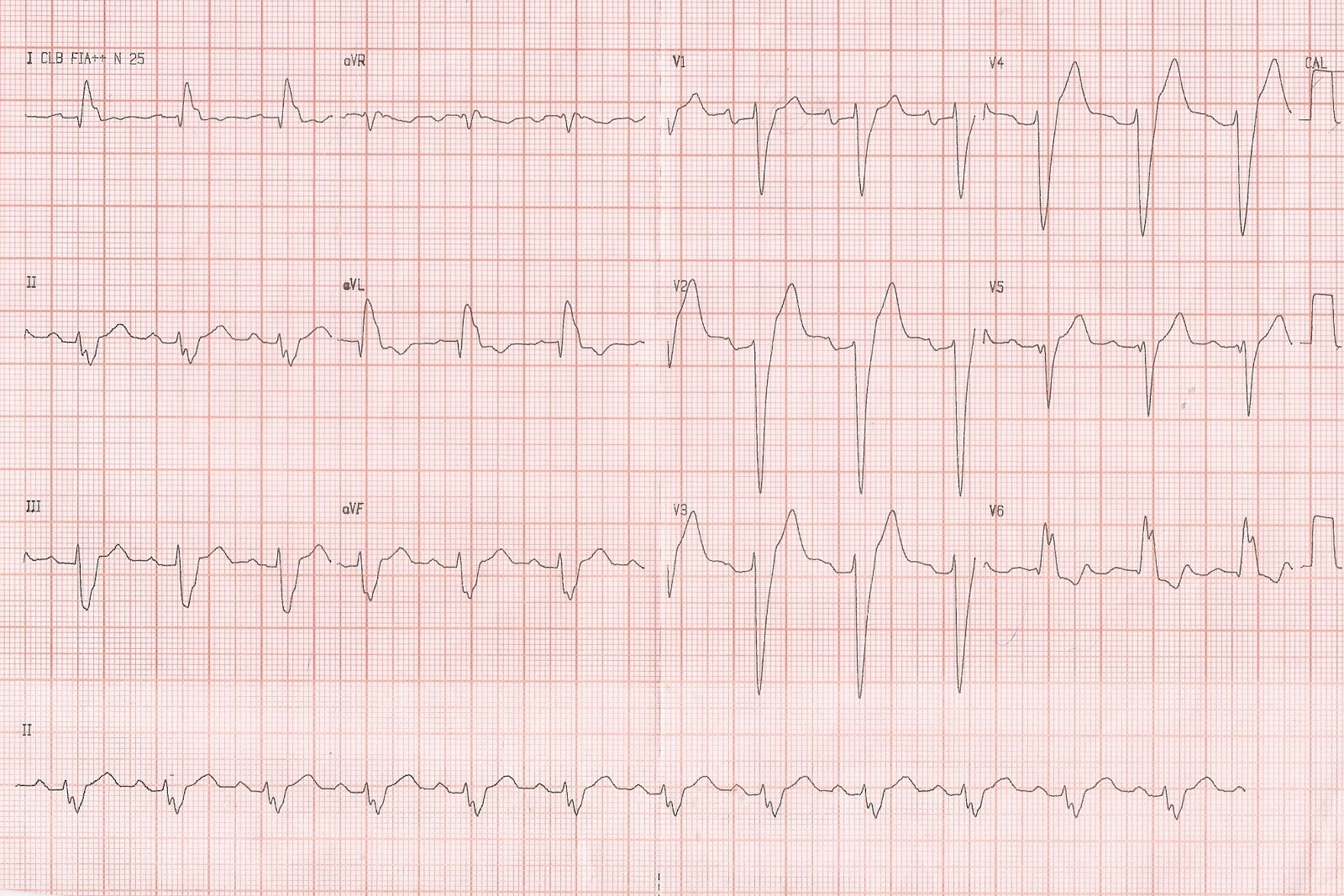 Blog de Eletrocardiografia: BRE E FUNÇÃO VENTRICULAR: ESCORE ...