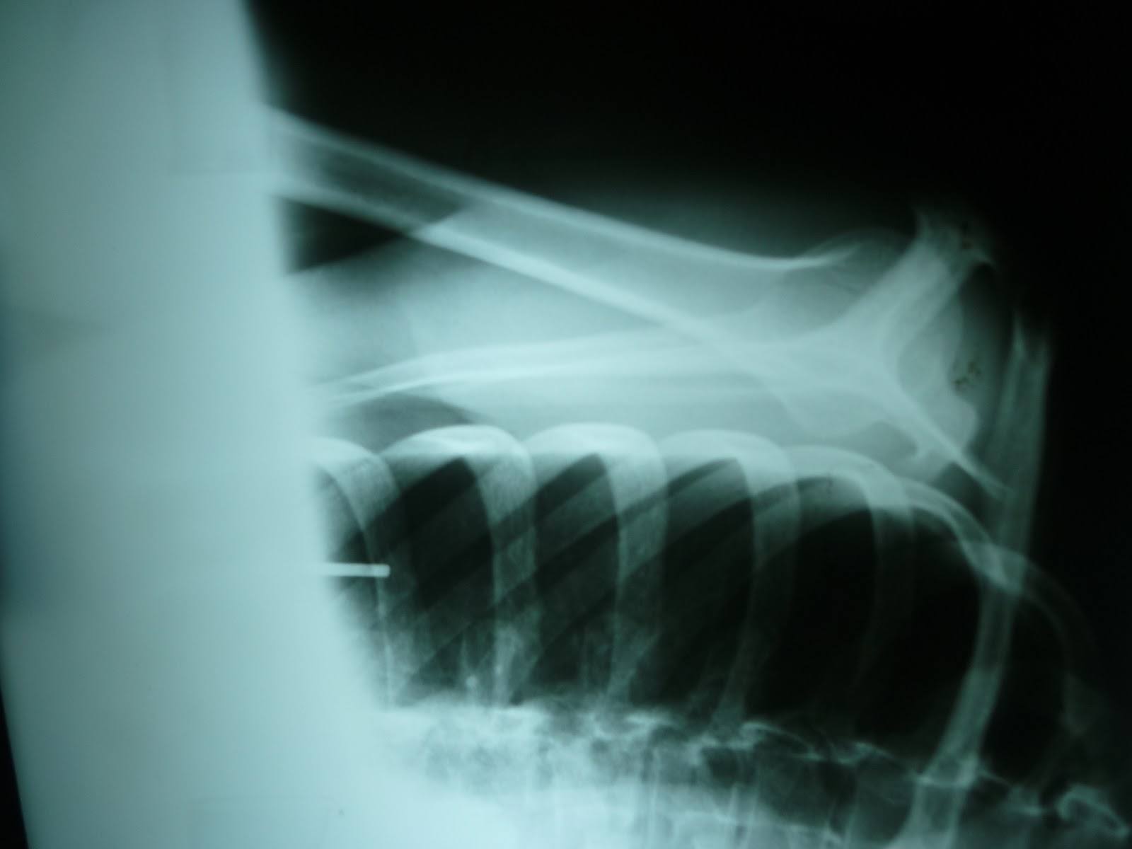 Rx011: Proyecciones Acromioclaviculares
