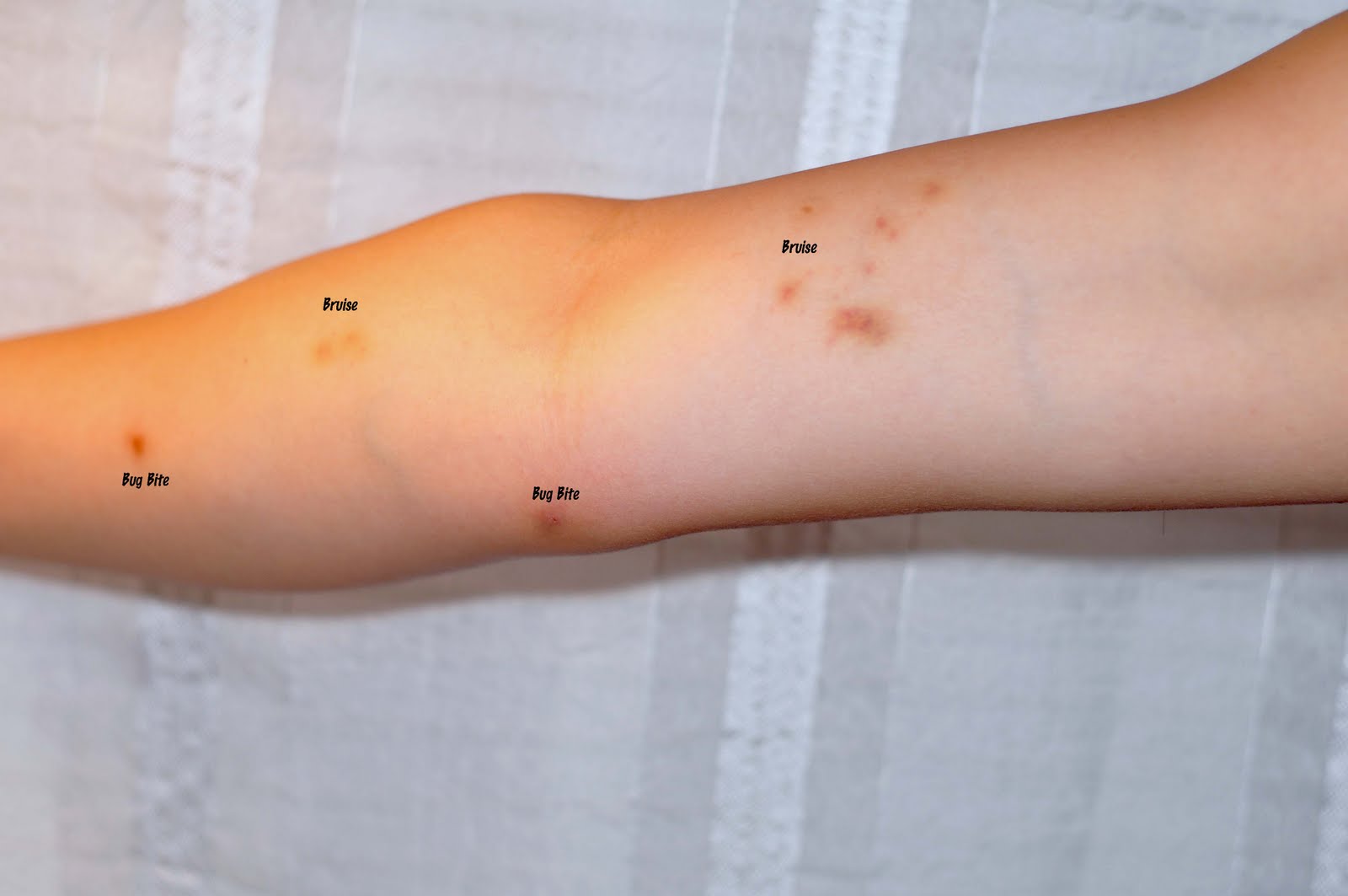 The Bills Bank: Day 247: My Poor Arm