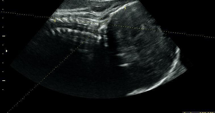 Ob/Gyn Updated : Smaller “Occiput-spine angle” during first stage of ...
