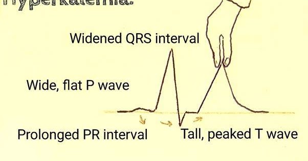 Medicowesome: ECG changes seen in hyperkalemia and hypokalemia mnemonic