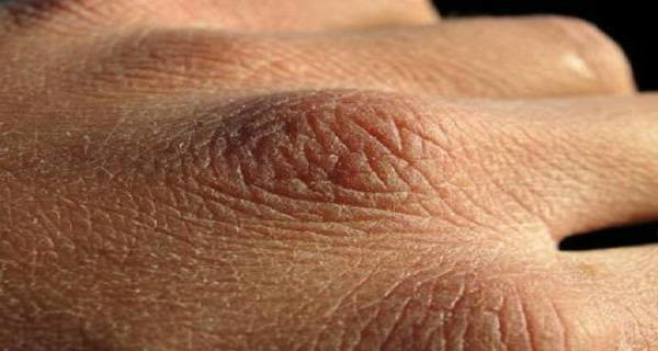 Recette naturelle pour guérir la peau craquelée des mains - Conseils ...