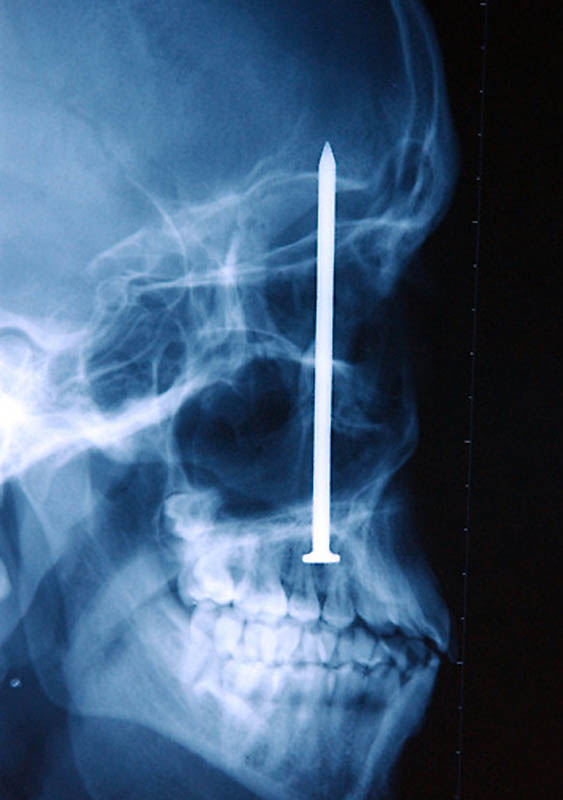Deformutilation: Disturbing X-Rays