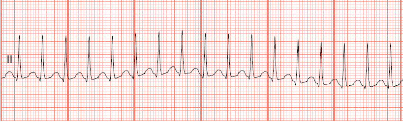 Basic EKG Rhythm Test 40