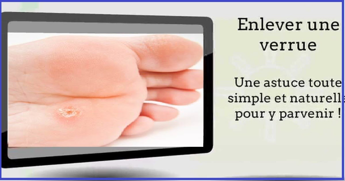 Comment soigner les verrues naturellement? ~ Sport et Santé