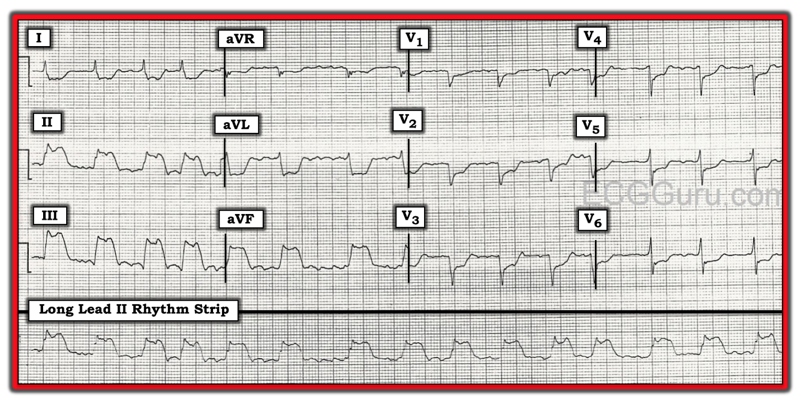 ECG Interpretation ECG Blog 161 Acute STEMI Abnormal Rhythm ecg-interpretation-ecg-blog-161-acute-stemi-abnormal-rhythm