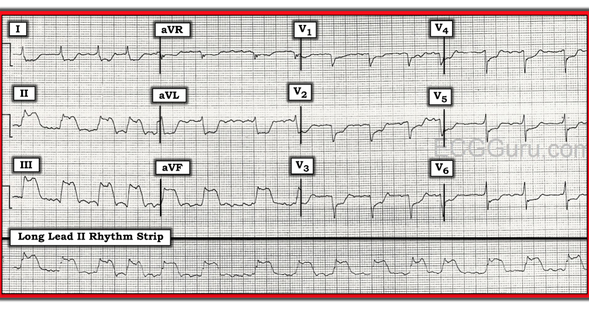 ECG Interpretation: ECG Blog #161 (Acute STEMI - Abnormal Rhythm)