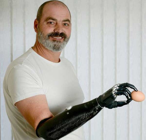 Nothing To Do With Arbroath: One-armed man's life transformed by world ...