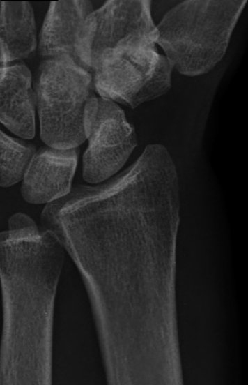 Dequervain’s Tenosynovitis-MRI - Sumer's Radiology Blog