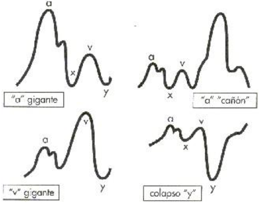 alteraciones pulso venoso cardiologia