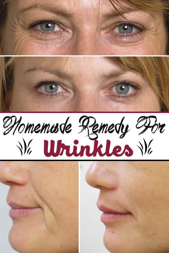 9 Effective Home Remedies To Get Wrinkle-Free Skin