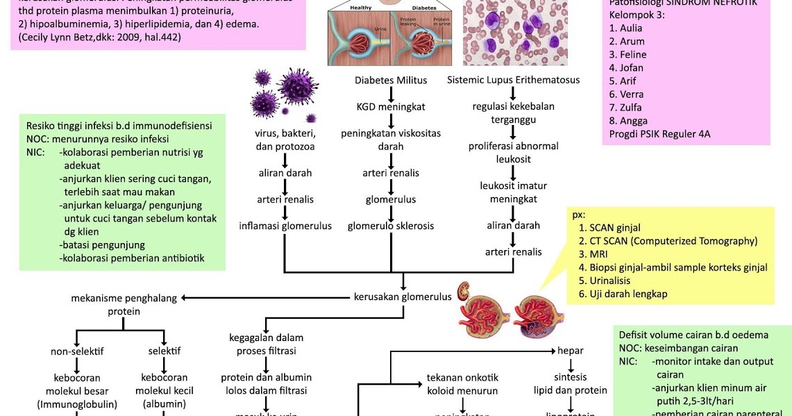 pathway sindroma nefrotik