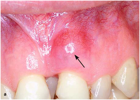 Odontogenic Infections-Oral Surgery Lecture Note ~ Dentistry and Medicine