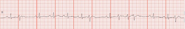 EKG Rhythm Strip Quiz 68