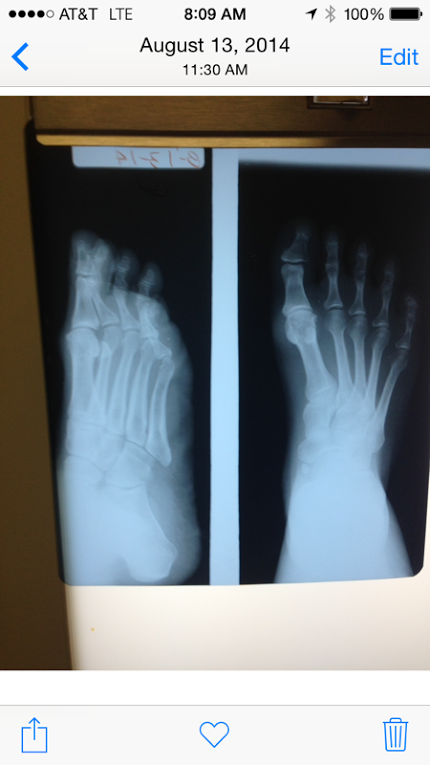 Foot and Ankle Problems By Dr. Richard Blake: Hallux Limitus Discussion ...