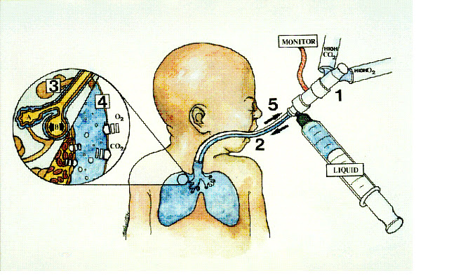 This14U: Liquid ventilation