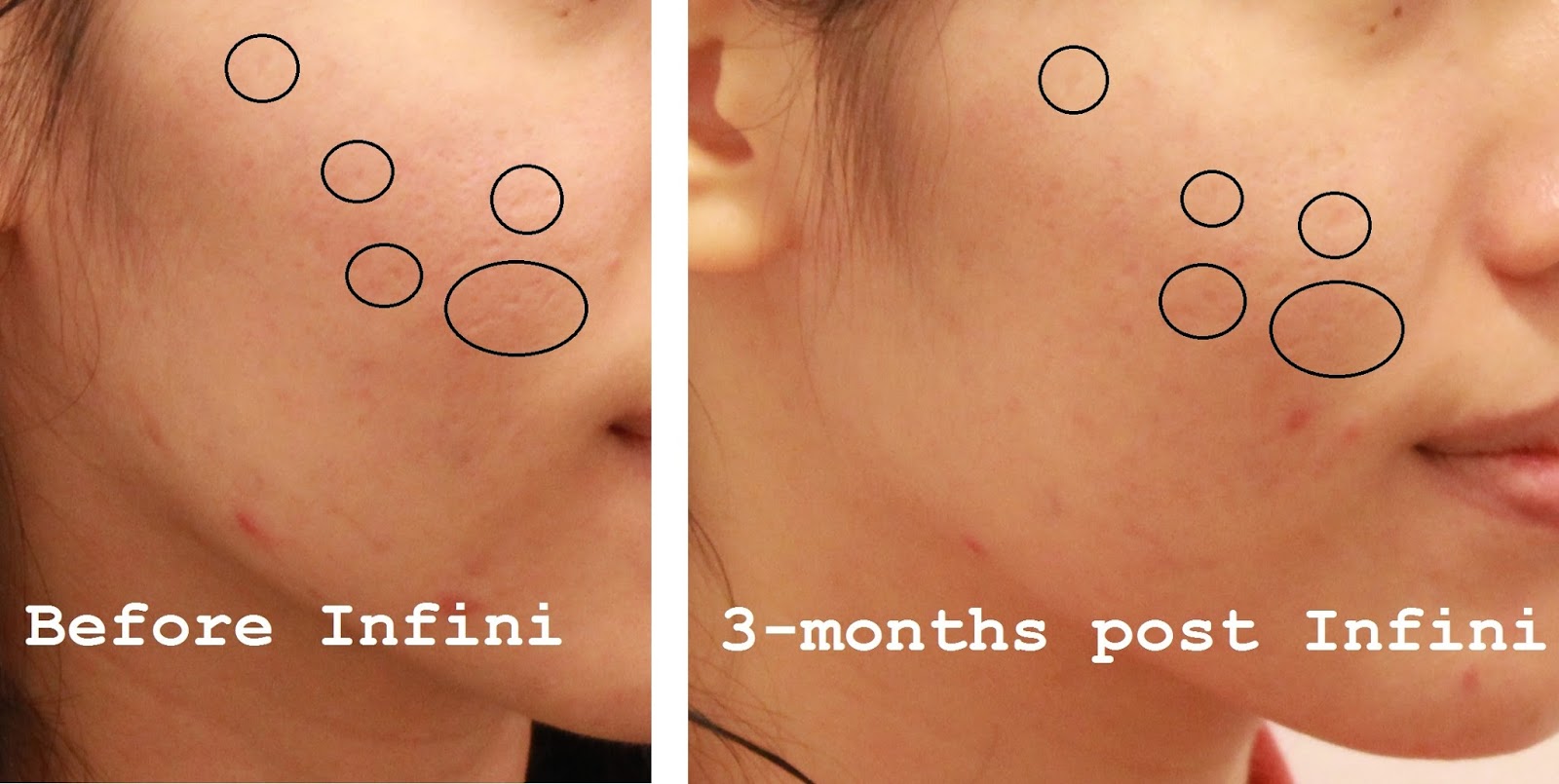 [Treatment] Infini Fractional Radiofrequency for Depressed Acne Scars ...