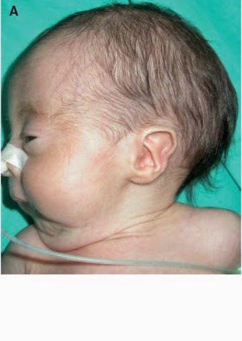 SÍNDROME DE EDWARDS