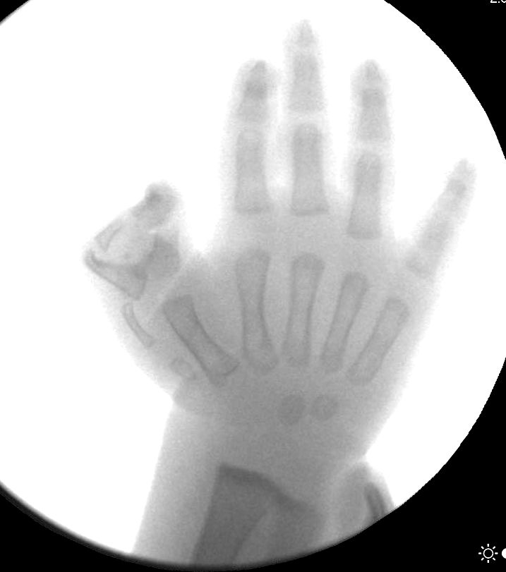 Three thumbs | Congenital Hand and Arm Differences | Washington ...