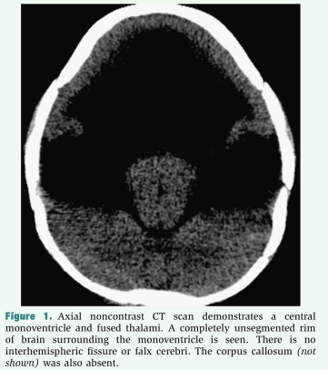 Lobar Holoprosencephaly-Mayo Radiology