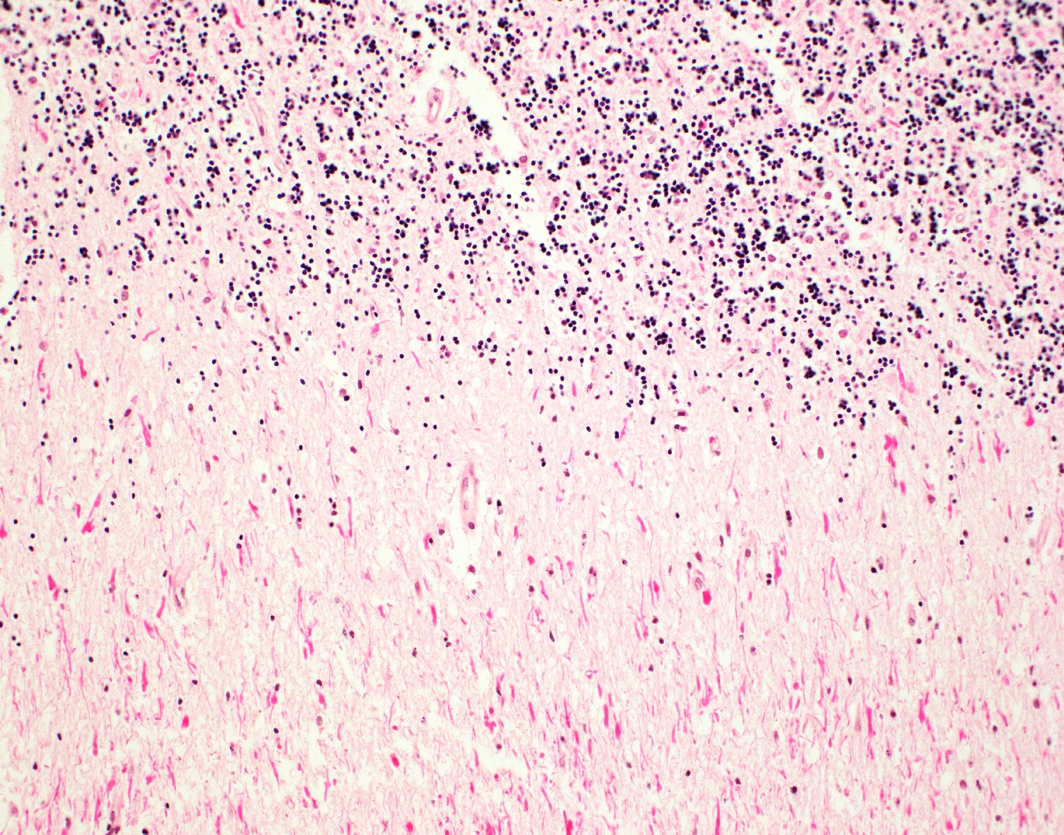 neuropathology blog: A case of Alexander disease