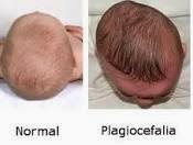 Por Patricia Silva: Plagiocefalia posicional