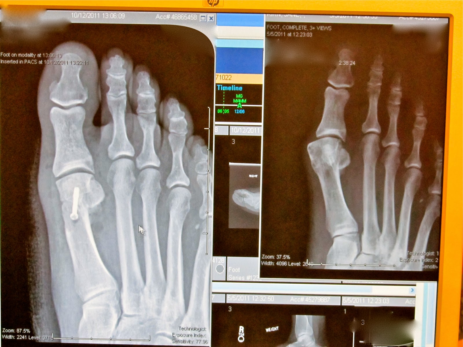 SUNFLOWER SNAPS: CREEPY RECOVERY