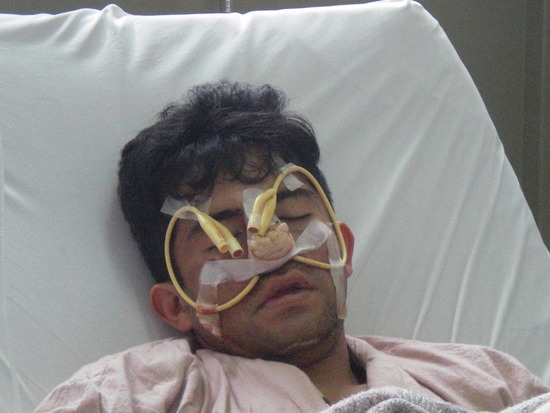 ENT for medical students: NOSE - Epistaxis