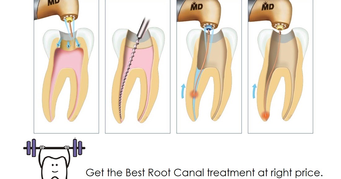 Root Canal Treatment Procedure - Dr.Syeds Dental Care