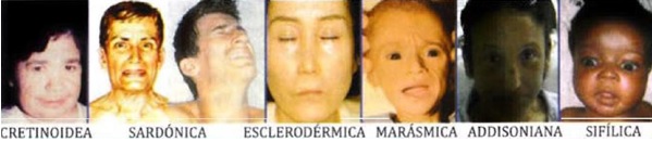 - Facie Sifílica : frente prominente y convexa, frente olímpica. La ...