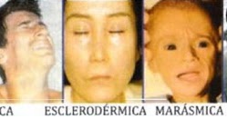 facie_cretinoidea_sardonica_esclerodermica_marasmica_addisoniana ...