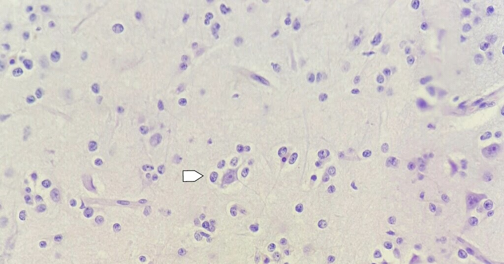 Pathology Room: CNS findings Perineuronal satellitosis oligodendroglioma