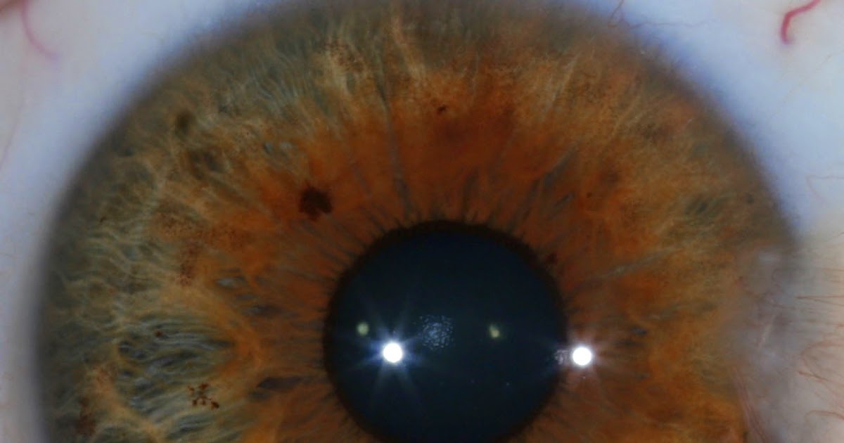 Multidimensional Iridology & Flower Essences : The Assessment of Iris ...