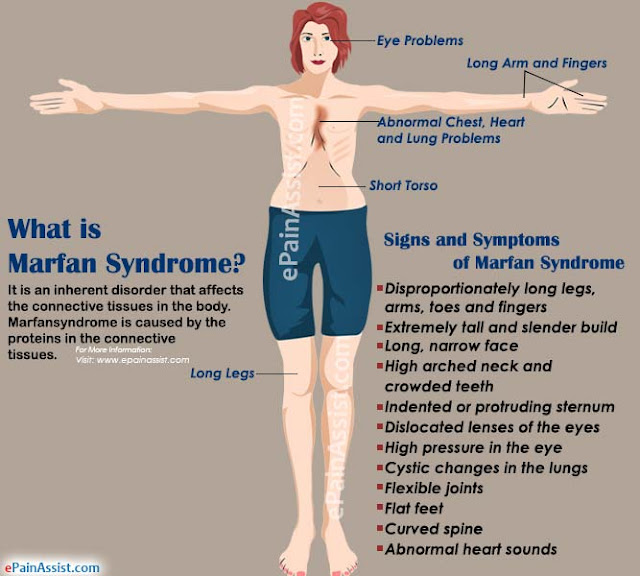 Marfan Syndrome : Causes, Diagnosis, Treatment - Healthy Living