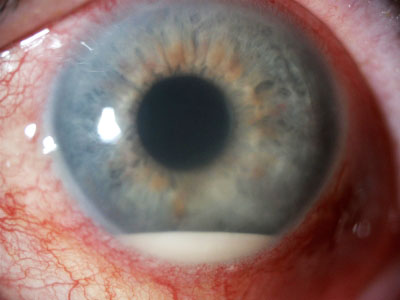 Residentes de familia en Lanzarote.: Imágenes en la consulta. HIPOSFAGMA.