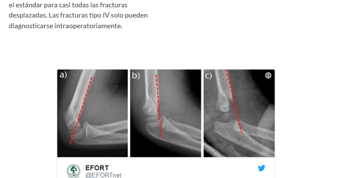 Revisiones_bibliográficas TyO_Web: Manejo de las fracturas ...