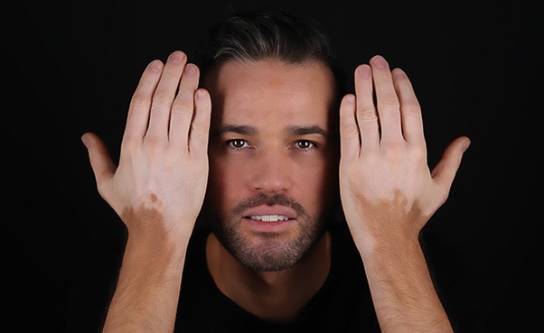 Penyakit Sopak Atau Vitiligo: Cara Terbaik Dan Selamat Untuk Merawat ...