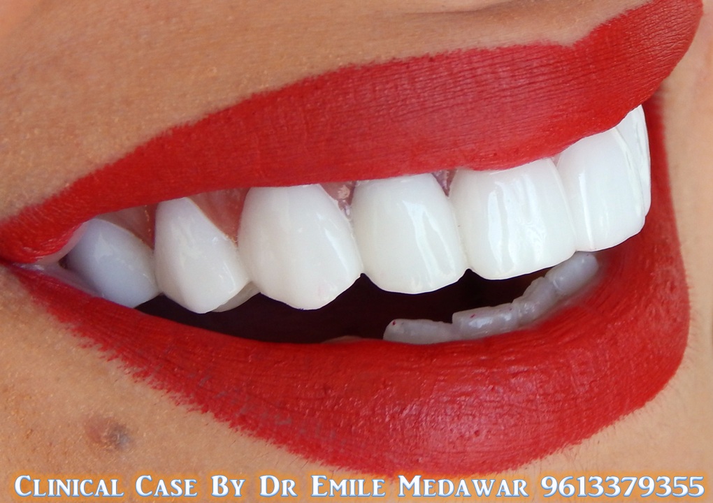 Facettes Dentaires Liban, Dr Emile Medawar, 00 961 3 379355: Souriez en ...