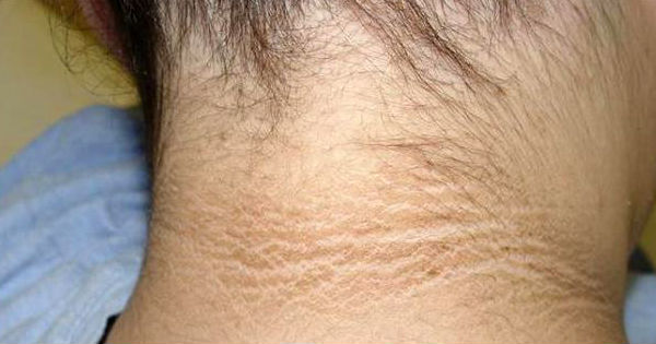 Penyebab Kulit Leher Menjadi Hitam dan Cara Mengatasinya