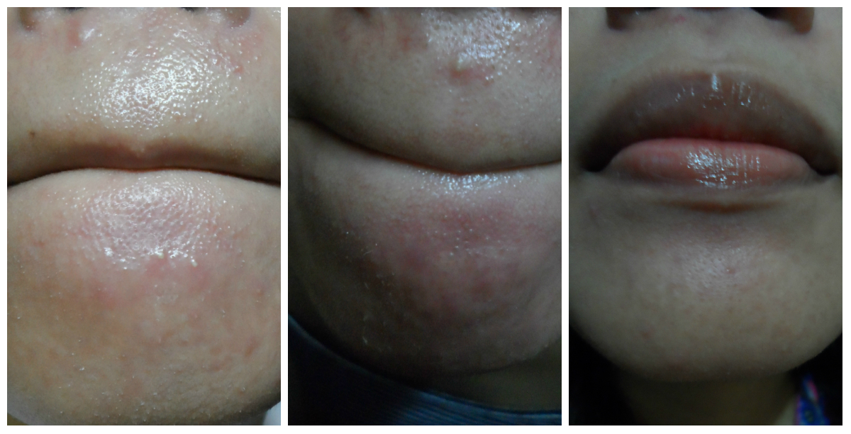 Prettythrifty: Maxi Peel Review : Before and After