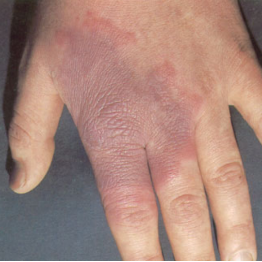 Caso 68: Infecciones por Erysipelothrix rhusiopathiae – Guía ...