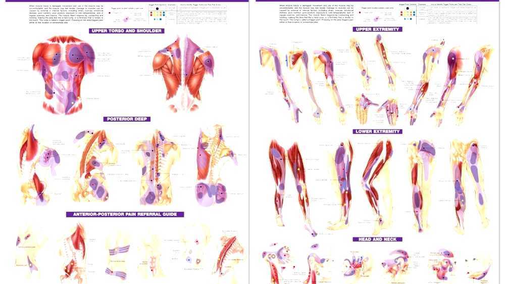 Myofascial trigger point