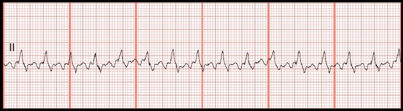 ECG Rhythm Strip Quiz 103
