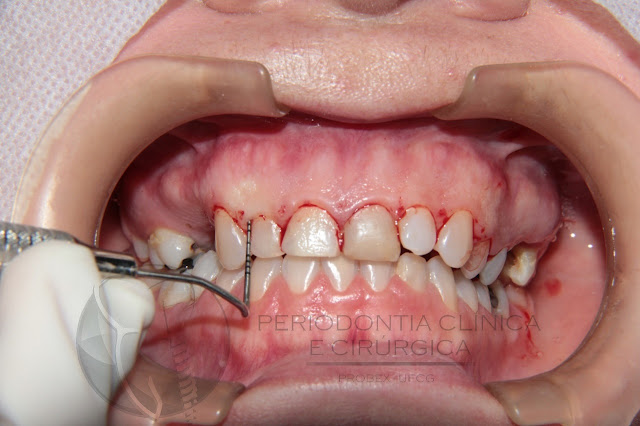 CIRURGIA PERIODONTAL NA ESTÉTICA DO SORRISO: RELATO DE CASO