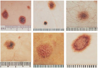 PUBLIC HEALTH: TUMOR MELANOCYTIC; Congenital Nevomelanocytic Nevus ...
